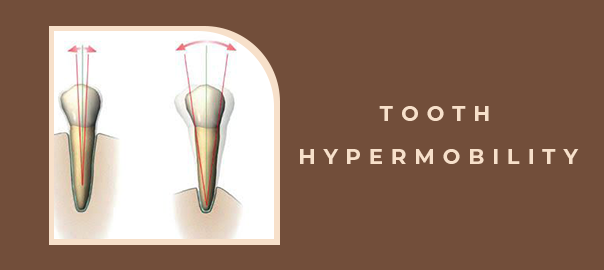 Tooth Hypermobility: Symptoms, Causes, Treatments at Clove Dental Clinic